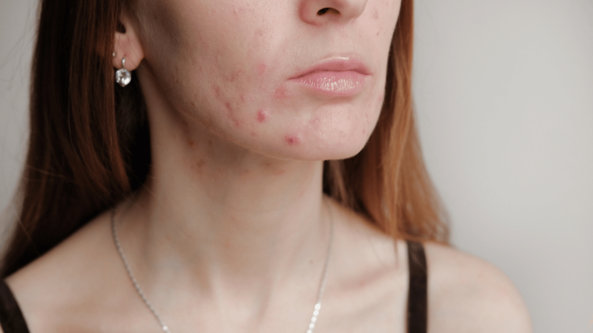 4 Foods That Can Trigger Acne (Backed by Science!) - Beoty®