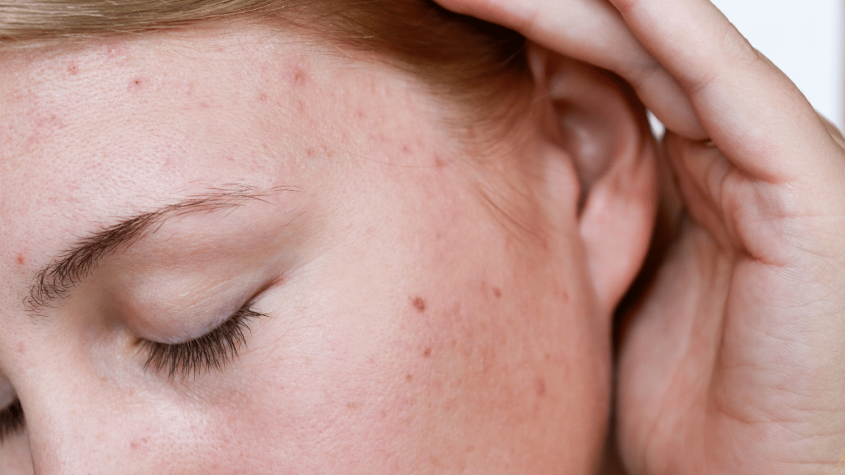 5 Surprising Causes of Acne Outbreaks - Beoty®