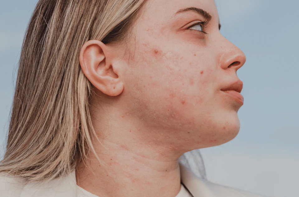 Can Alcohol Cause Breakouts? - Alcohol and Skin Health